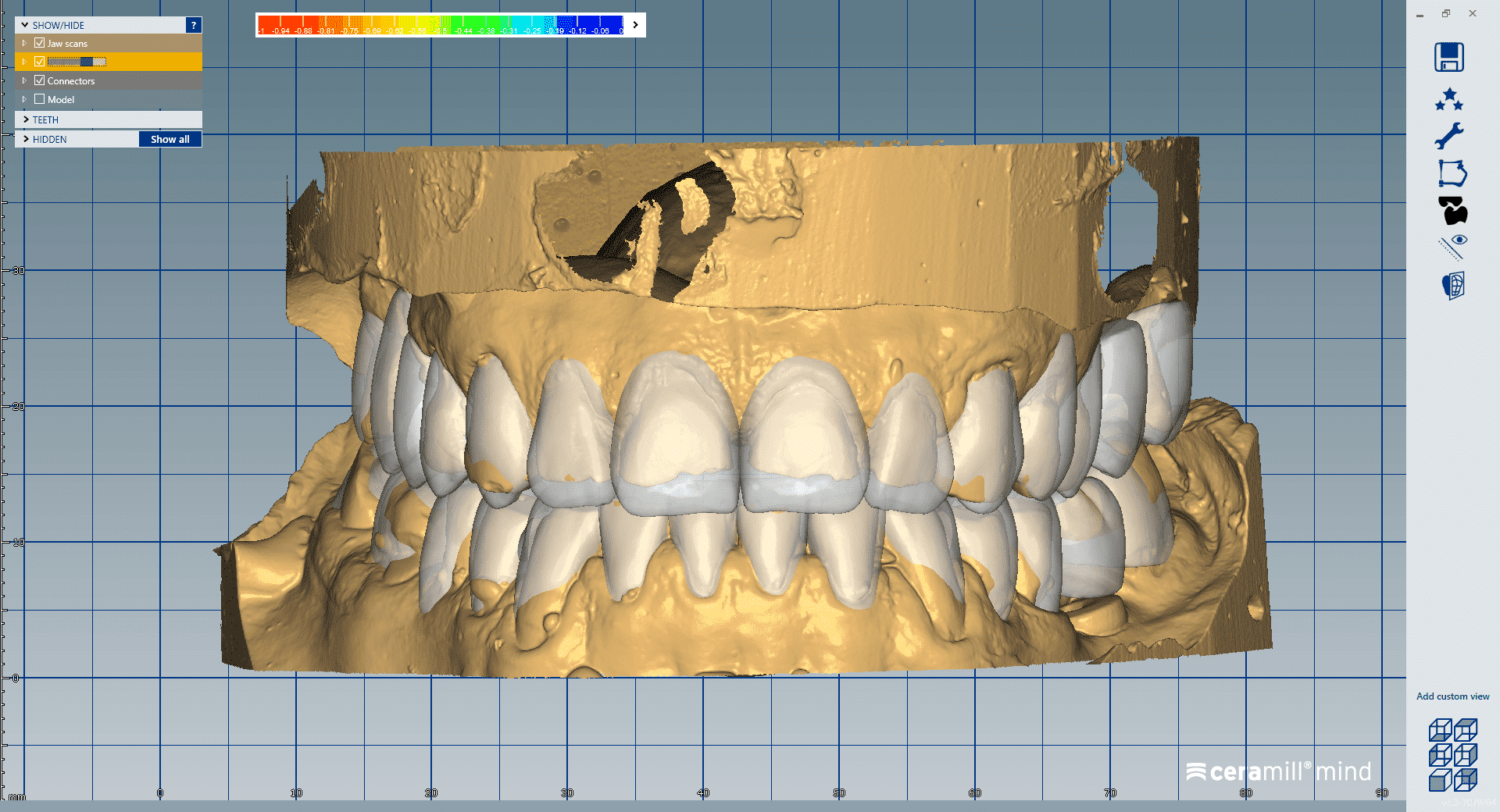 Align Technology has acquired Exocad for $419 million - Institute of ...