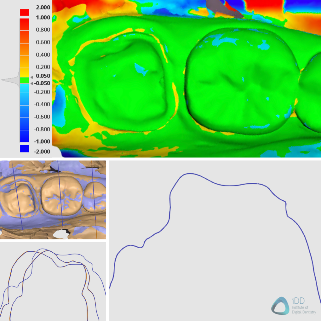 iDD Compares: Dentsply Sirona CEREC Primescan vs. Straumann Virtuo Vivo ...
