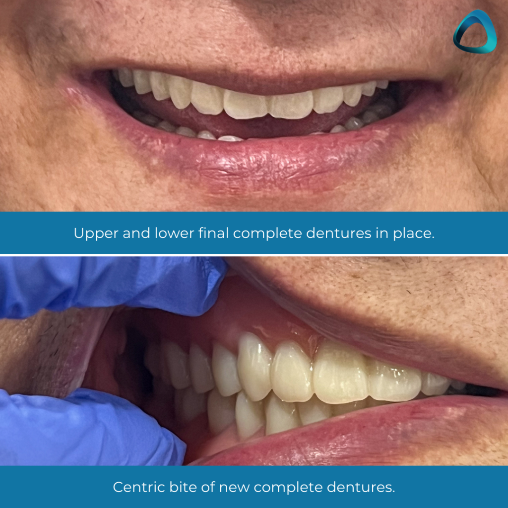 Digital Workflows for Digital Dentures