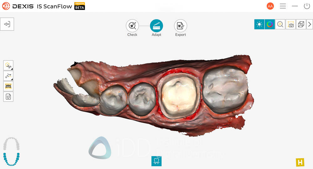 DEXIS IS 3800 Wireless Intraoral Scanner Review by iDD